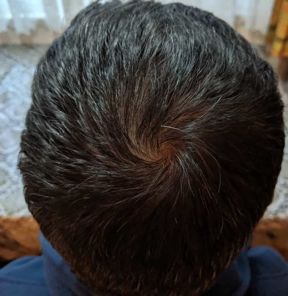 My Attempt At Slowing Hair Loss With Good Guy Wellness